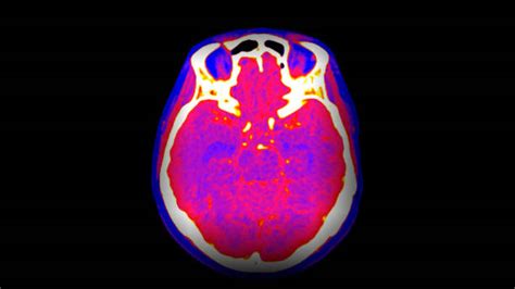 180개 이상의 출혈성 뇌졸중 이미지 스톡 사진 그림 및 Royalty Free 이미지 Istock