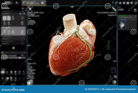 Comprehensive Ct Scan Of The Knee Joint Detailed Anatomy And Cartilage