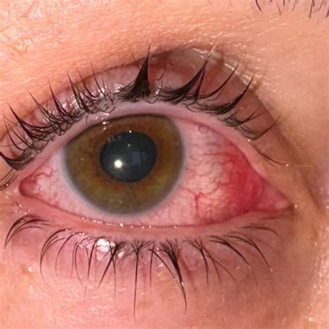 Asperox Bulaşık Tableti Patladı Gözüme Kimyasal Sıçradı Ciddi Hasar