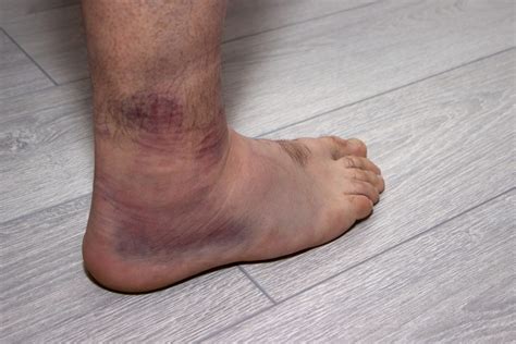 Ankle Sprain Nhs Inform