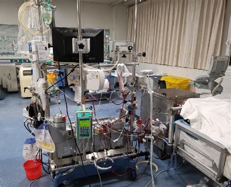Figure 2 From Extracorporeal Membrane Oxygenation Using A Modified Cardiopulmonary Bypass System