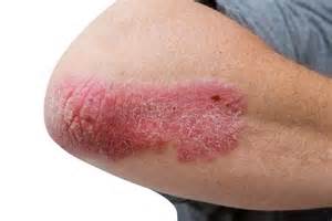 23 Pictures Of Skin Rashes With Symptoms Treatments And Expert Tips