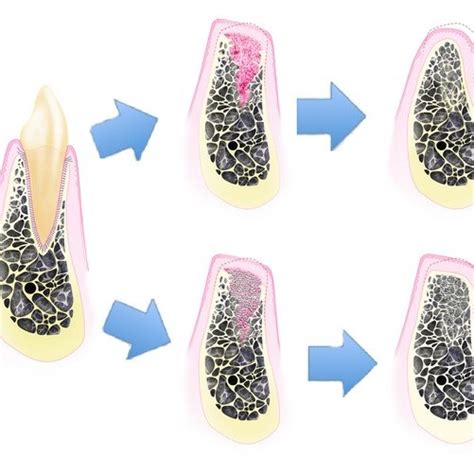 Healing Of The Extraction Socket With Postextractive Implant