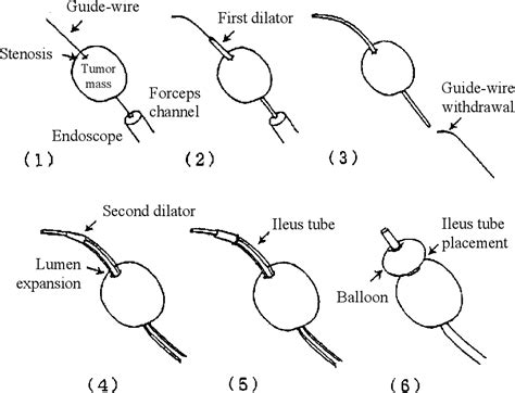 PDF 3 Endoscopic Decompression Of Carcinoma Ileus Of The Left Colon Semantic Scholar