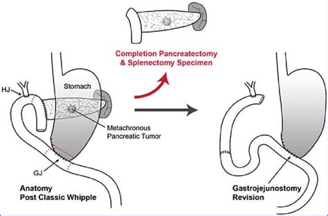 Instruments Used In Whipple Procedure At George Arrellano Blog