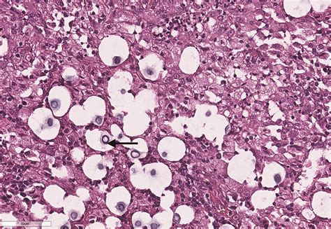 Cryptococcus Histology