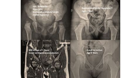 While Browsing Linkedin I Occasionally See Posts About Acetabuloplasties In Ddh Mahmoud Smida