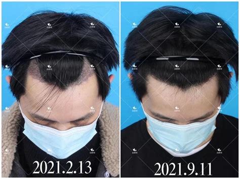 男性m型脱发发际线种植 微医（挂号网）