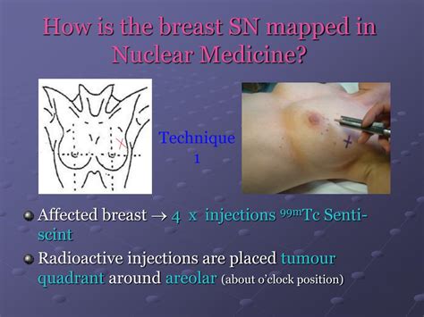 PPT BREAST SENTINEL NODE LOCALISATION BIOPSY PowerPoint Presentation ID