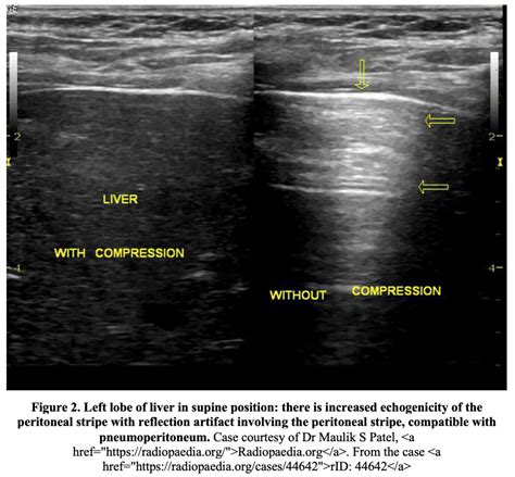 Complications Of ERCP ED Presentations Evaluation And Management EmDocs