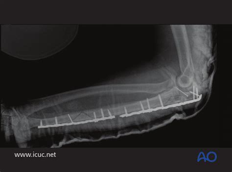 Open Reduction Internal Fixation For Anterior Transolecranon Fracture Dislocation