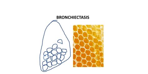 Types Of Bronchiectasis