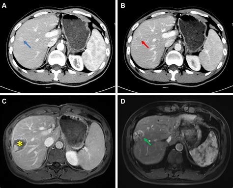 Tweetorial Transarterial Chemoembolization With Radiofrequency Ablation Versus Surgical