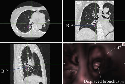 Figure 1 From Right Lower Lobe Superior Segmentectomy In A Patient With A Displaced Bronchus