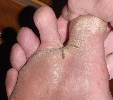 How This Barefoot Runner Deals With Cracks In Her Feet