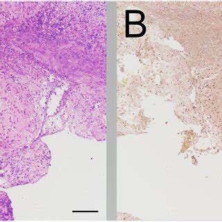 Pathological Findings Of The Genital Lesion Using The Surgical Download Scientific Diagram