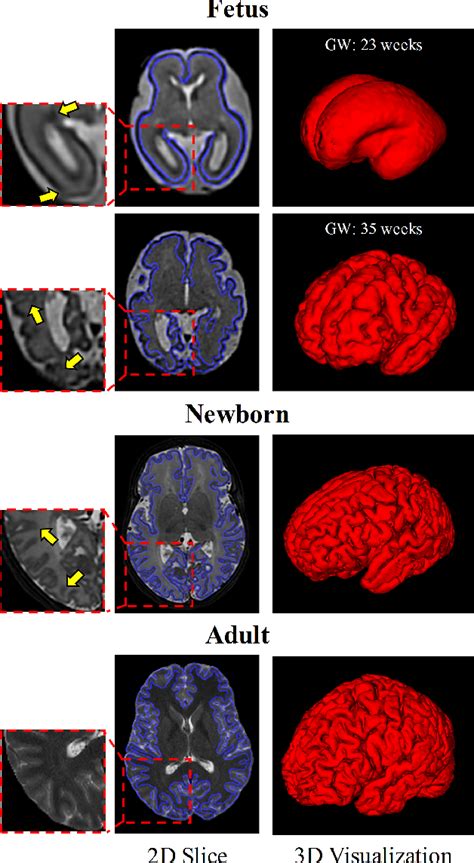 Figure 1 From A Deep Attentive Convolutional Neural Network For Automatic Cortical Plate