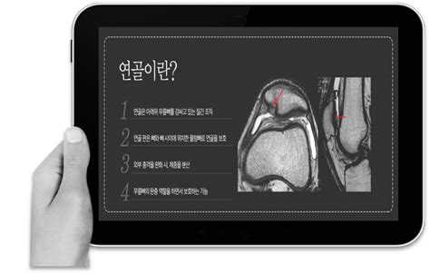 무릎중점병원의 연골연화증 비수술 재활부터 줄기세포 재생치료 까지 네이버 블로그