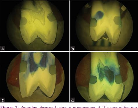 Figure 1 From Comparison Of Microleakage On Class V Composite