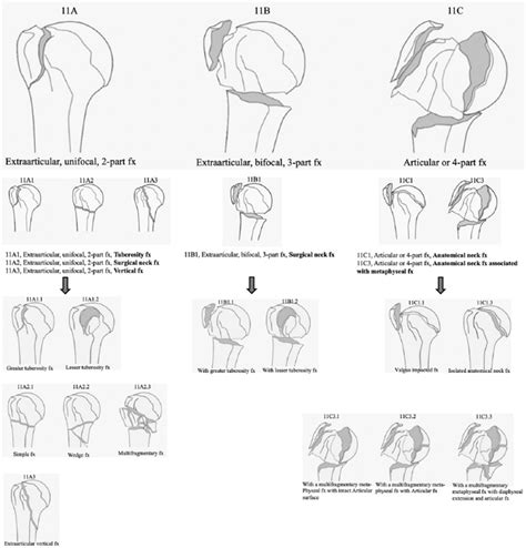 Otaao Classification For Proximal Humeral Fractures Fx Download