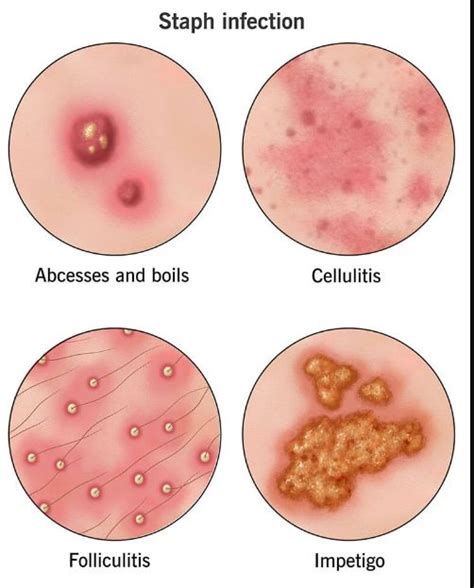 Entsar Abdelghani On Linkedin Staphylococcus Aureus Symptoms On Skin