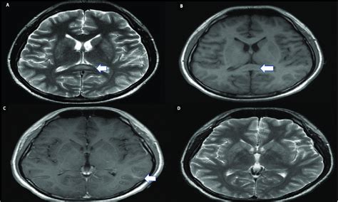 Magnetic Resonance Imaging Of Brain Hyperintense And Hypointense