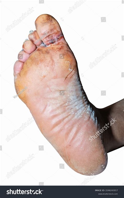 Large Laceration Between Big Toe Foot Stock Photo Shutterstock