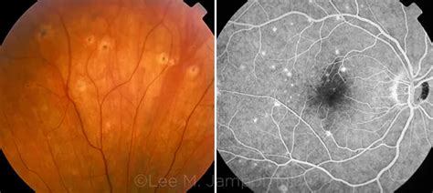 Emerging Viral Infections American Academy Of Ophthalmology