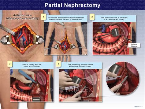 Partial Nephrectomy Trialquest Inc