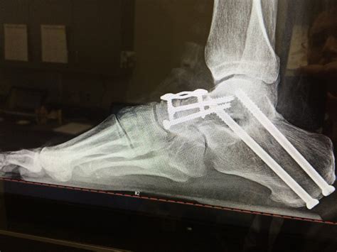 Foot And Ankle Conditions Dr Richard Zell