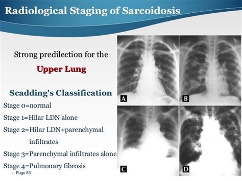 Sarcoidosis And Orphan Lung Disease