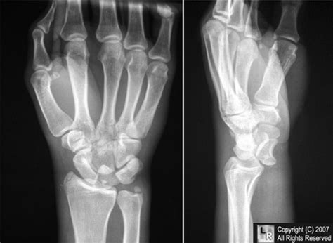 Dislocated Wrist X Ray Radiocarpal Fracture Dislocation Hand