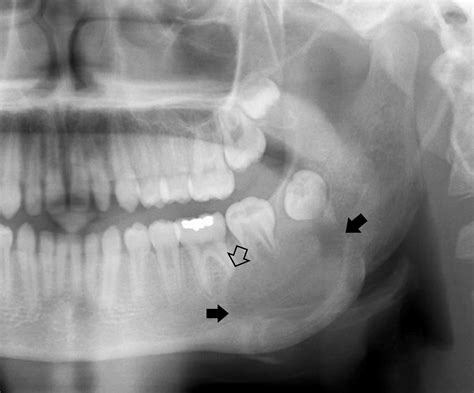 Ameloblastoma X Ray At Mabel Singer Blog
