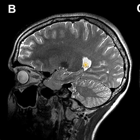 The Interventricular Foramen Was Identified And Set As The Optimal
