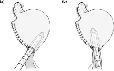 Gastrojejunostomy Is Performed A The Stapler Was Inserted Toward The