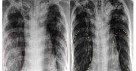 기관지염·해소·천식폐 질환 줄기세포로 치료할 수 있다