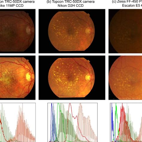 Pdf Automated Brightness And Contrast Adjustment Of Color Fundus Photographs For The Grading