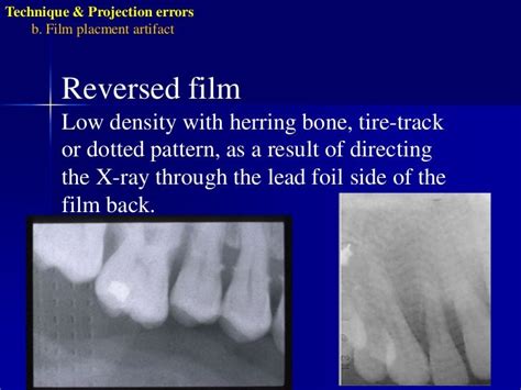 Radiographic Errors And Artifacts
