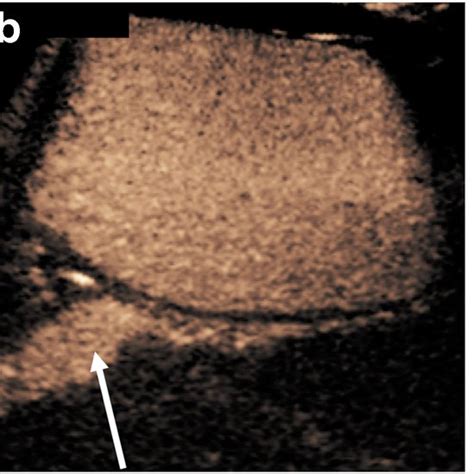 Grading Vesicoureteral Reflux Vur On Contrast Enhanced Voiding Download Scientific Diagram