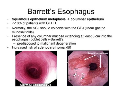 Ppt Gerd Barretts Esophagus Dysphagia Hiatal Hernia And