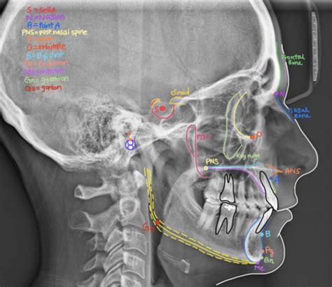 Anterior Nasal Spine Cephalometric