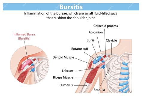 Premium Vector Shoulder Bursitis Medical Illustration