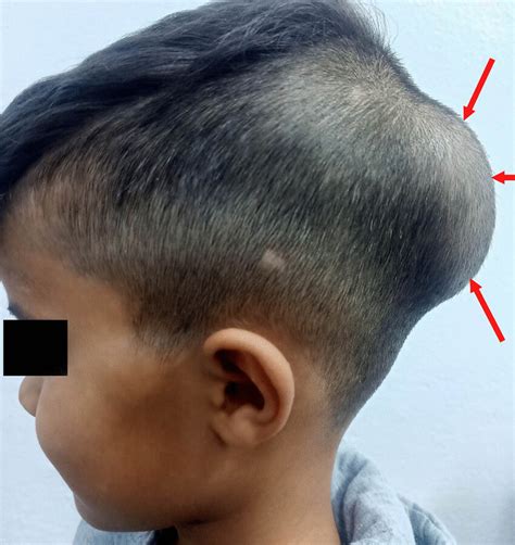 Photograph Of The Patient Showing A Parietal Swelling Red Arrows Download Scientific Diagram