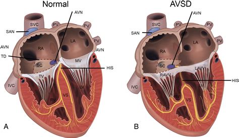 Atrioventricular Septal Defect