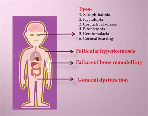 Follicular Hyperkeratosis Vitamin A Deficiency