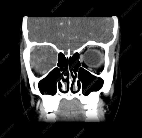 Orbital Pseudotumor On Ct Stock Image C043 0426 Science Photo Library
