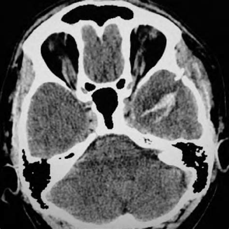 Non Contrasted Cranial Ct Scan Showing Left Squamous Bone Temporal