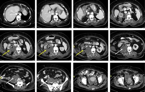 Emphysematous Pyelonephritis Radiology Cases