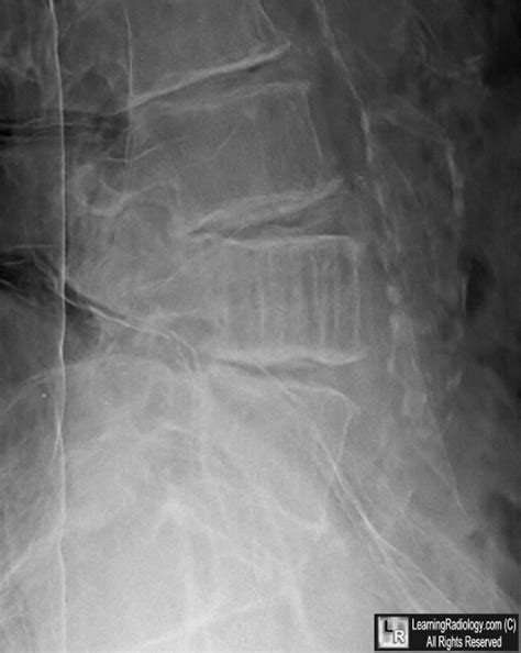 Learningradiology Hemangioma Spine Vertebra