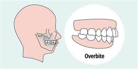 Overbite Common Dental Problems Gullotta Orthodontics